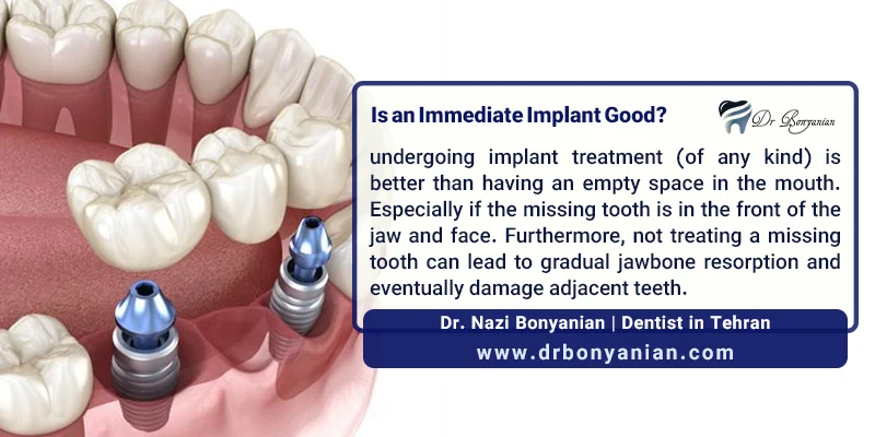 Immediate Dental Implants: The Complete Guide (Benefits & Risks)