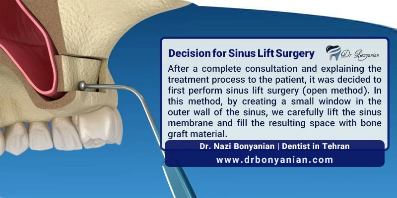 What is Sinus Lift Surgery? All You Need to Know | Dr. Bonyanian