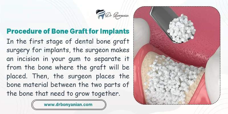 Dental Bone Grafting: Procedure, Recovery, Costs & Why You Need It
