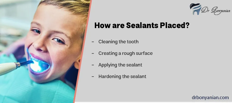 Dental Sealants: Effective Cavity Prevention & Benefits Explained