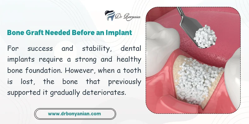 Dental Implant After Bone Graft: The 6-Month Healing Timeline