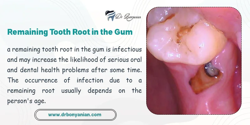 Piece of Tooth Left After Extraction? 8 Symptoms & Dangers